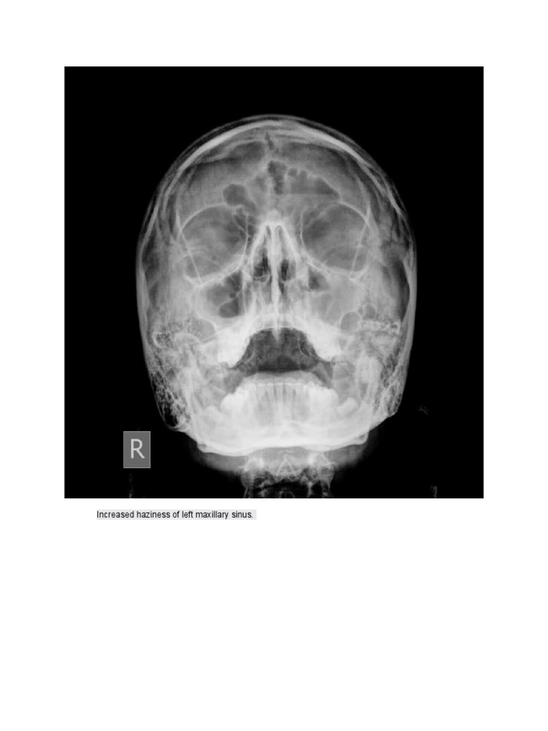 Sinusitis X Ray | PDF