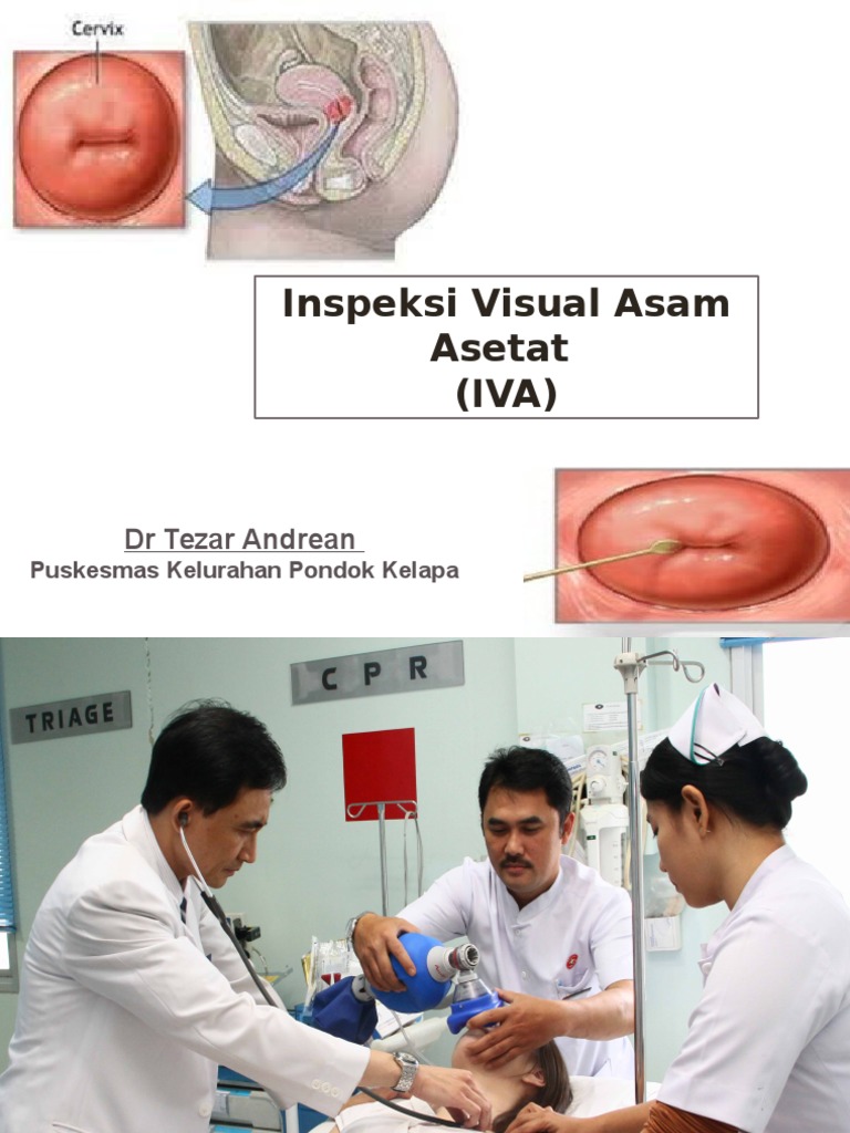 Inspeksi Visual Asam Asetat untuk Kanker Serviks | PDF