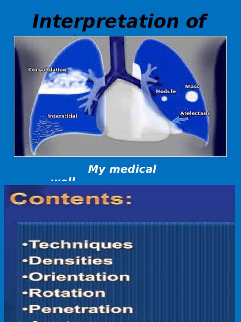 Chest X-ray Interpretation Guide | PDF