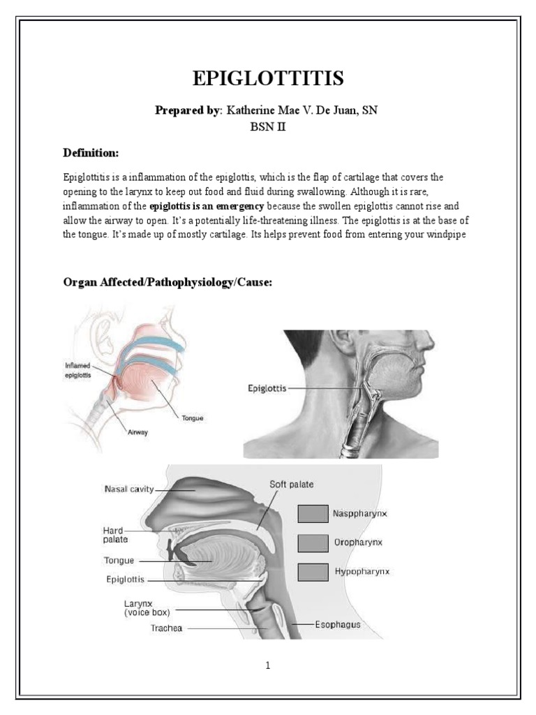 Epiglottitis Report | PDF | Respiratory Tract | Medical Specialties