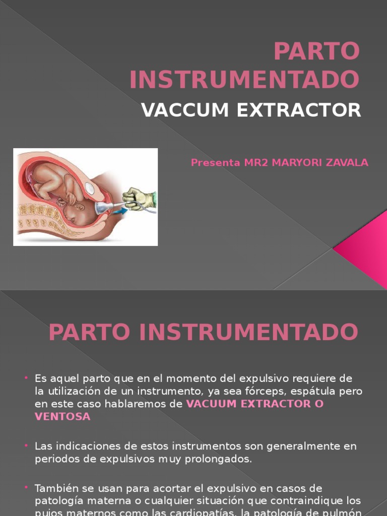 Uso del Vacuum Extractor en Partos | PDF | Parto | Especialidades Medicas