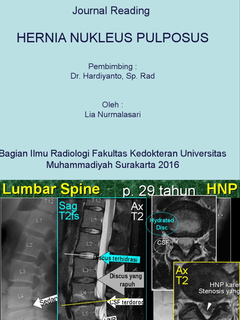Hernia Nukleus Pulposus: Pembimbing: Dr. Hardiyanto, Sp. Rad | PDF ...