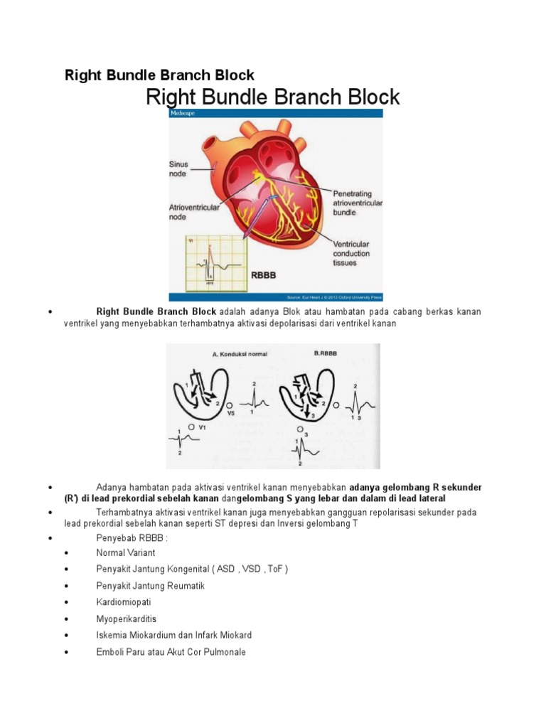 Right Bundle Branch Block | PDF