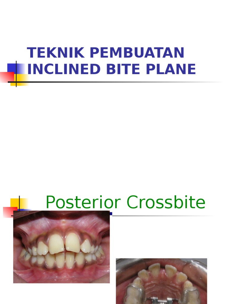 Teknik Pembuatan Inclined Bite Plane | PDF