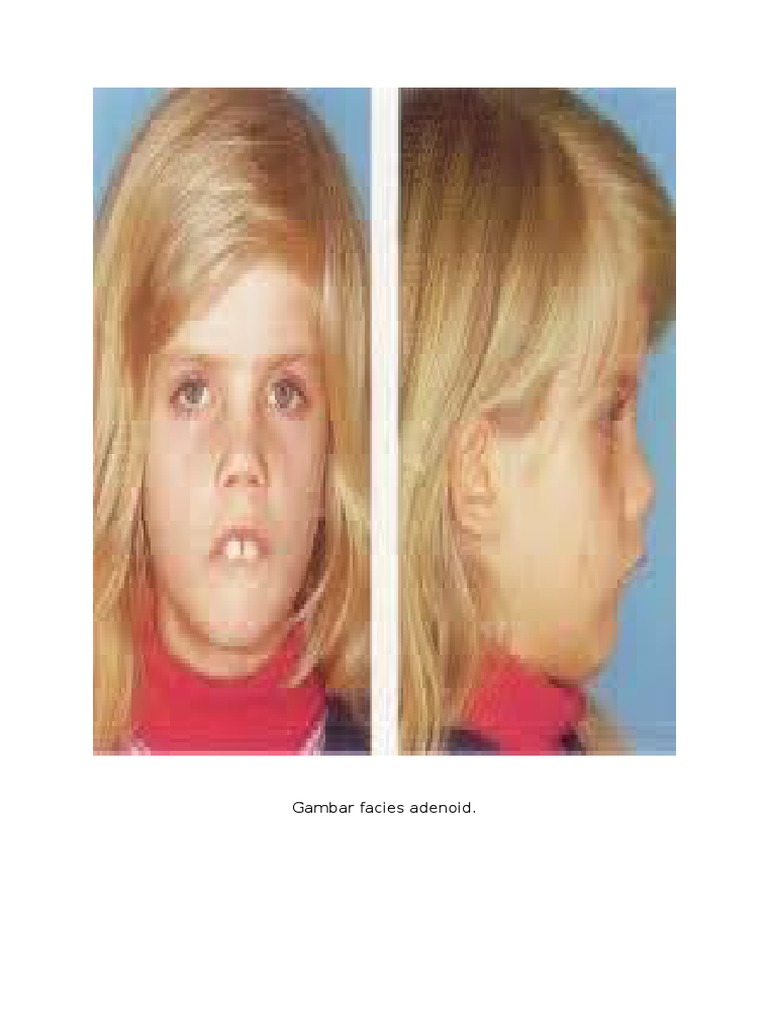 Gambar Facies Adenoid | PDF