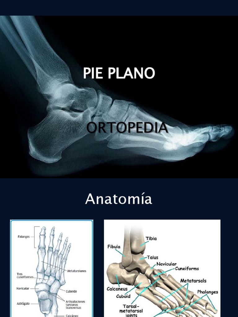Pie Plano, Pie Valgo, Pie Varo | Pie | Sistema musculoesquelético