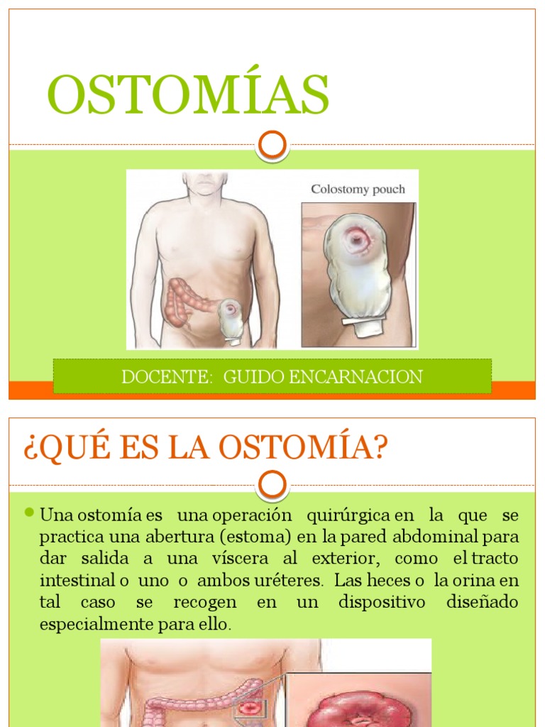 OSTOMIAS | Intestino grueso | Gastroenterología