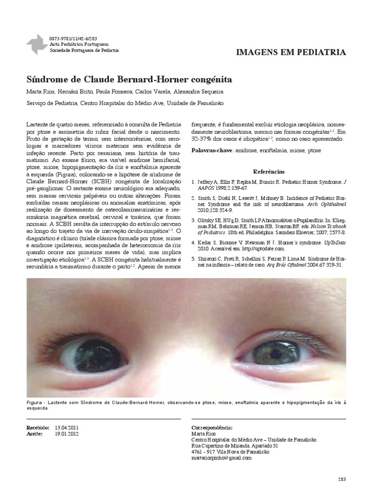 Síndrome de Claude Bernard-Horner | PDF | Ciências da Saúde | Doenças e ...