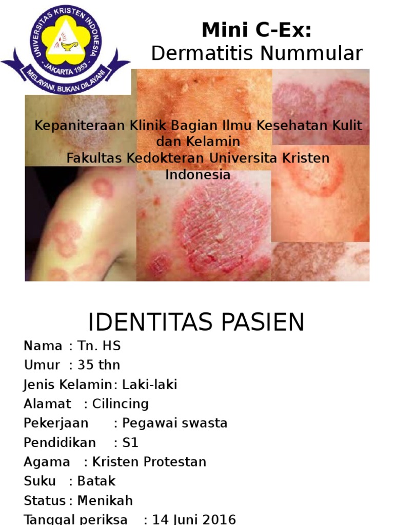 Mini Cex Dermatitis Nummular | PDF