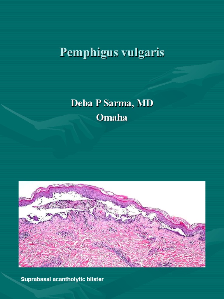 Pemphigus Vulgaris | Autoimmune Disease | Epidemiology