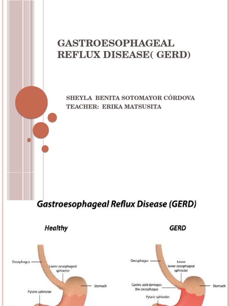 Gastroesophageal Reflux Disease (Gerd) : Sheyla Benita Sotomayor ...