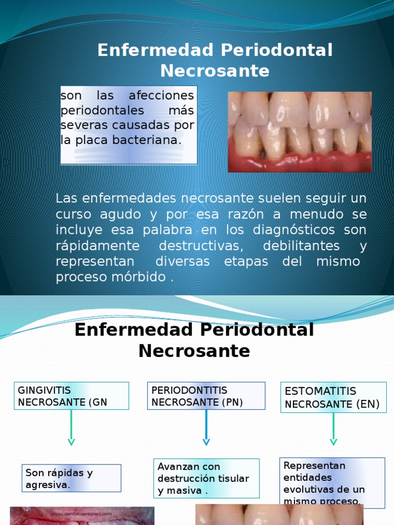 Enfermedad Periodontal Necrosante.pptx