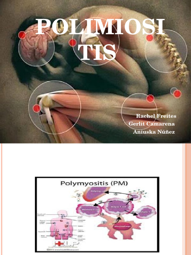 Polimiositis RAFP 10-1112 | PDF | Medicina | Ciencias de la Salud