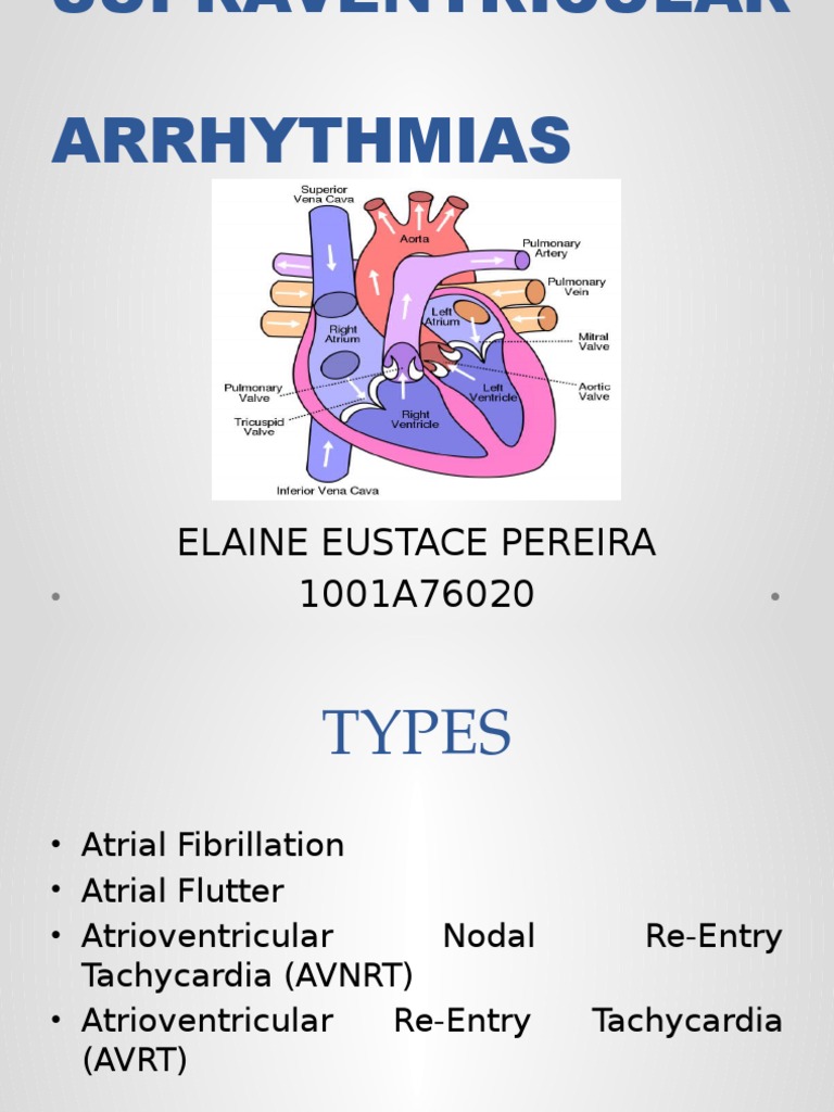 Supraventricular Arrhythmias (Seminar) | Cardiac Arrhythmia ...