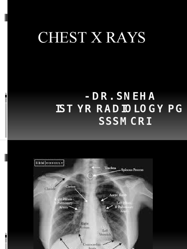 Chest X Rays: - DR - Sneha Istyr Radiology PG Sssmcri | PDF