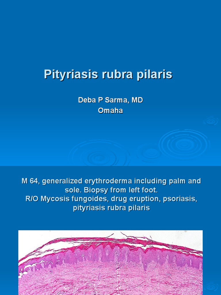 Pityriasis Rubra Pilaris. M 64, Left Foot | PDF | Pathology | Cutaneous ...