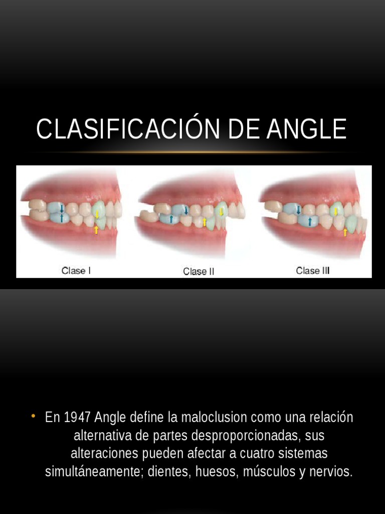 Clasificación de Angle | Odontología | Diente humano