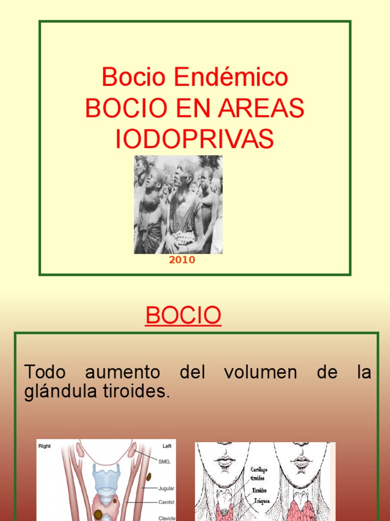 Bocio Endémico: Causas y Clasificación | PDF | Tiroides | Glándulas