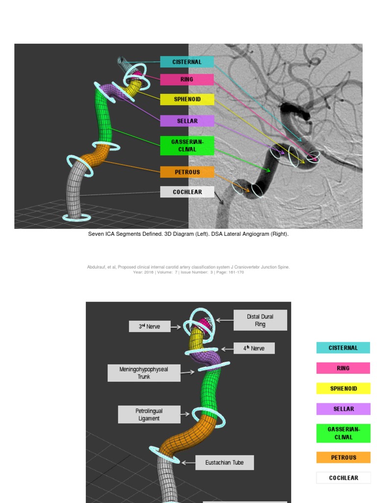 Cisternal: Seven ICA Segments Defined. 3D Diagram (Left) - DSA Lateral ...