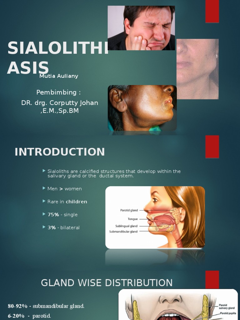 Sialolithiasis | PDF | Medical Specialties | Clinical Medicine