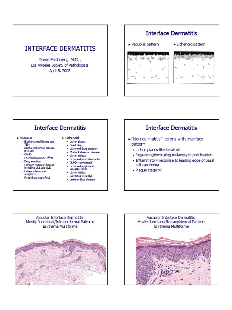 2008 04 Lecture 1 Interface Dermatitis Frishberg | PDF | Cutaneous ...