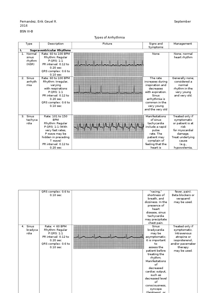 Fernandez, Erik Geuel R. September 2016 Bsn Iii-B Types of Arrhythmia ...