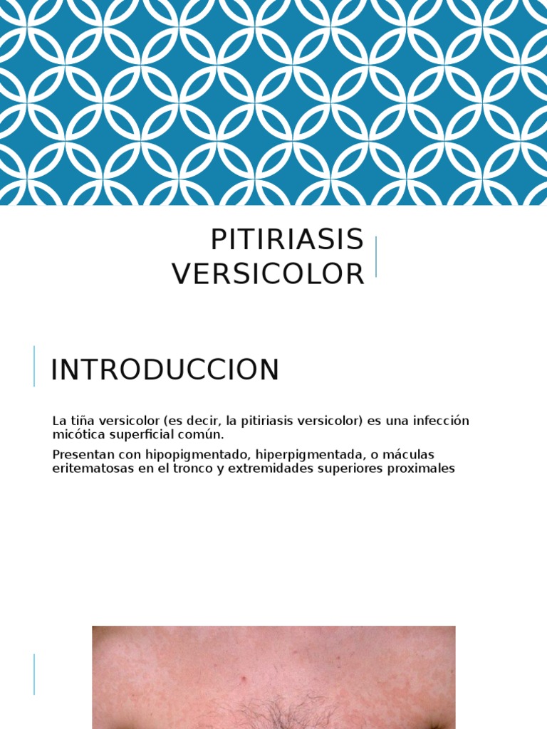 Pitiriasis Versicolor: Diagnóstico y Tratamiento | PDF | Especialidades ...