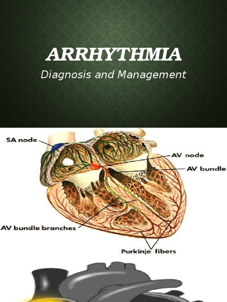 Arrhythmia: Diagnosis and Management | Download Free PDF | Cardiac ...