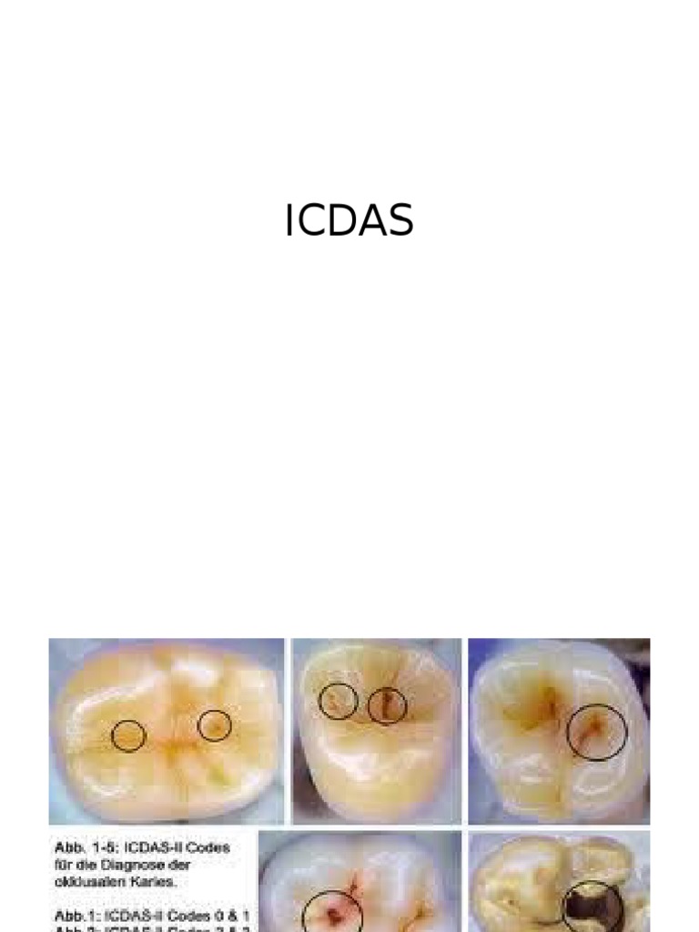 ICDAS | PDF