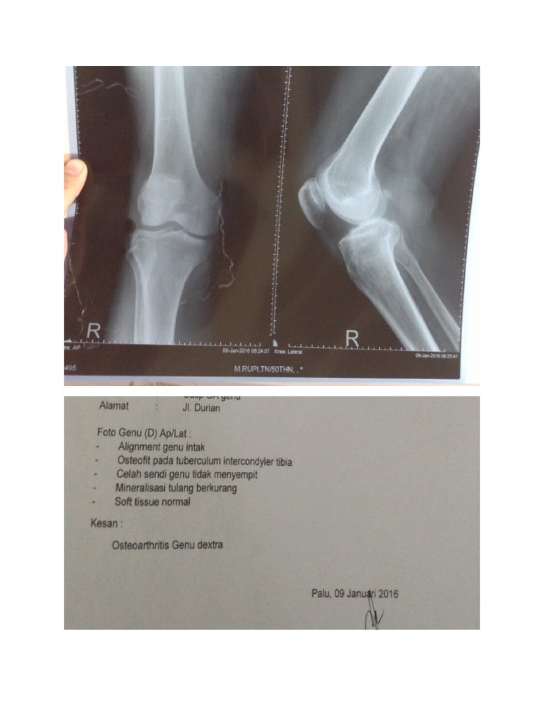 Genu Radiologi | PDF