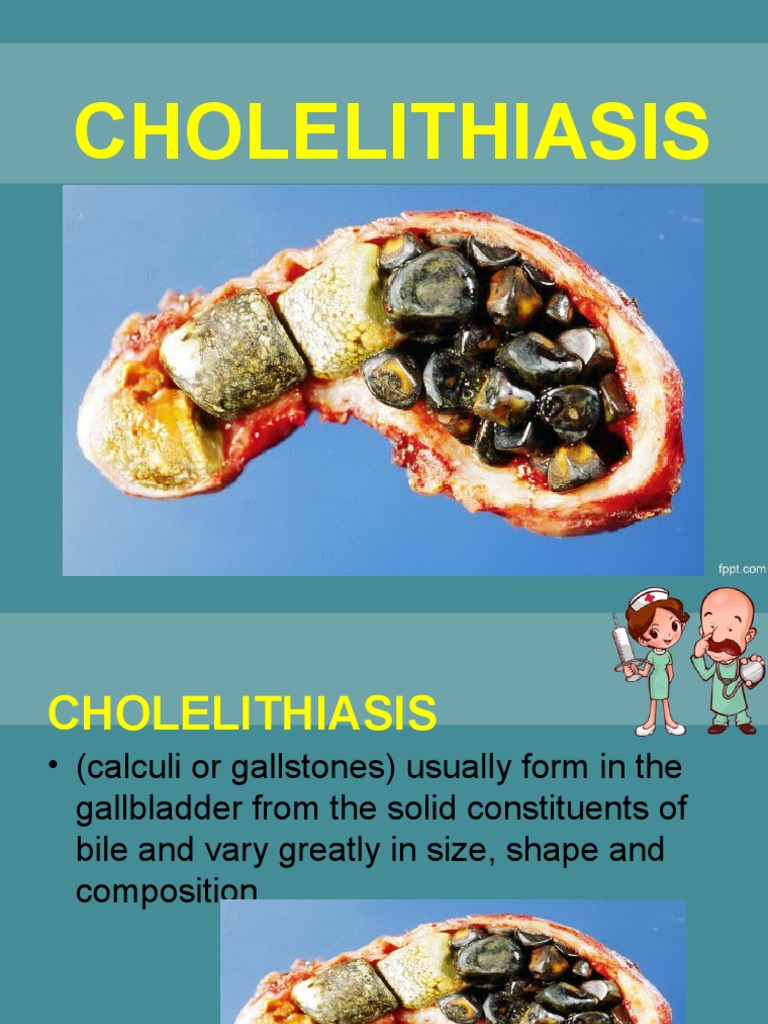 CHOLELITHIASISS.ppt | Bile | Gallbladder
