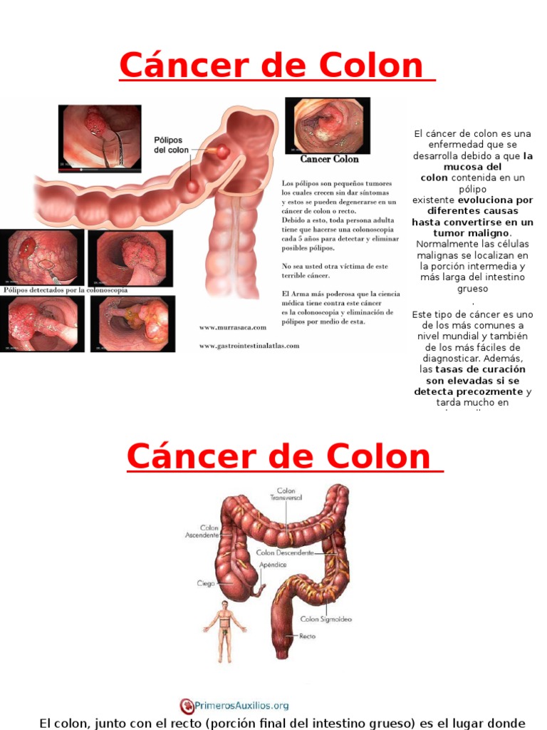 Cáncer de Colon | PDF | Cáncer colonrectal | Cáncer