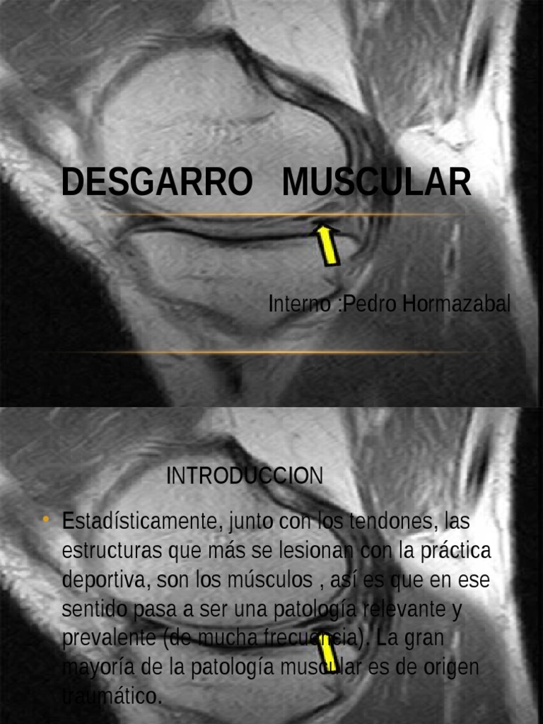 Desgarro Muscular | PDF | Músculo | Anatomía humana