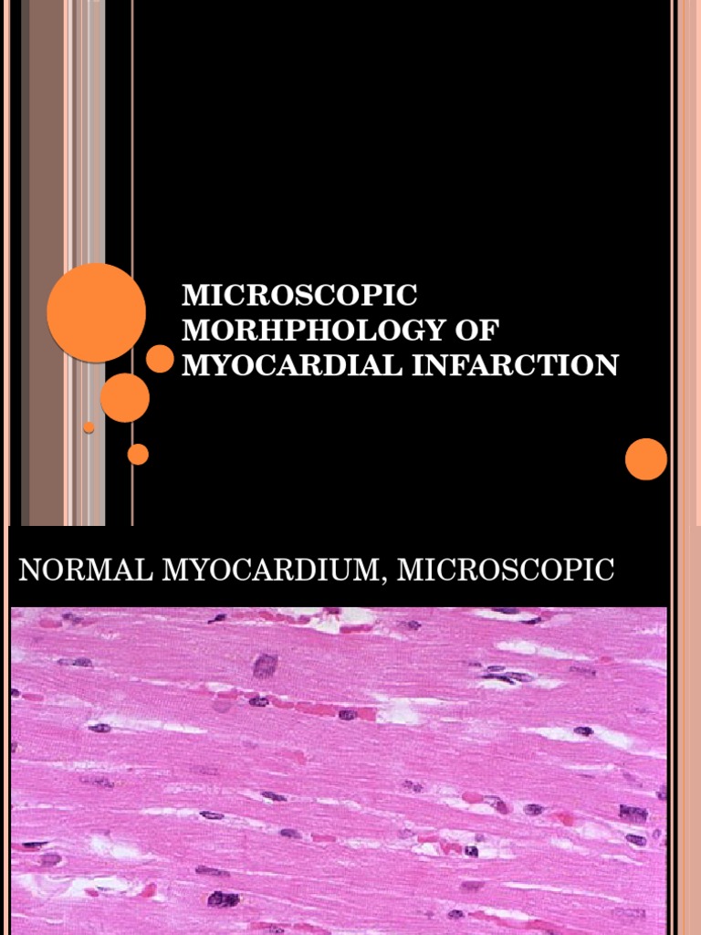 Microscopic Morphology Myocardial Infarction | PDF