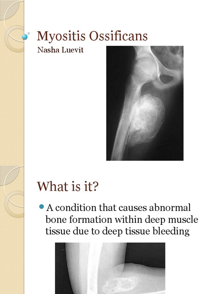 Myositis Ossificans | PDF