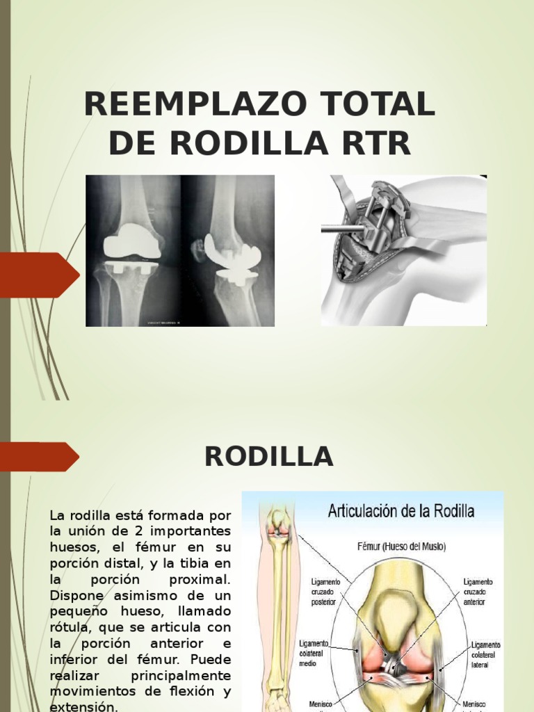 Reemplazo Total de Rodilla Rtr | Rodilla | Ciencia de la danza
