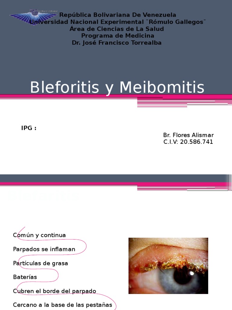 Blefaritis y Meibomitis: Diagnóstico y Tratamiento | PDF ...