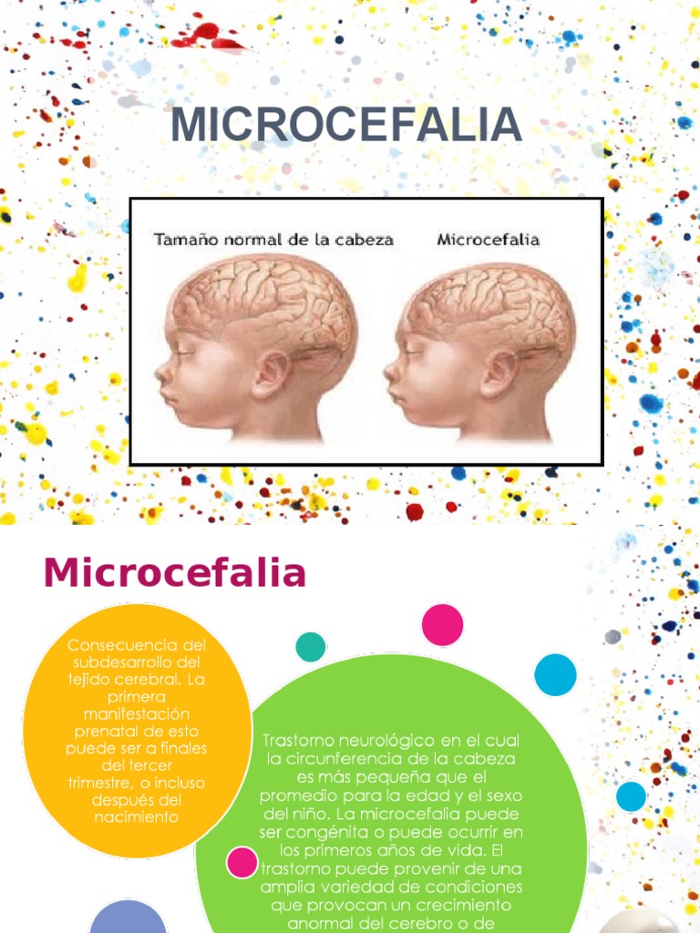 Microcefalia: Causas y Diagnóstico | PDF | Enfermedades y trastornos ...