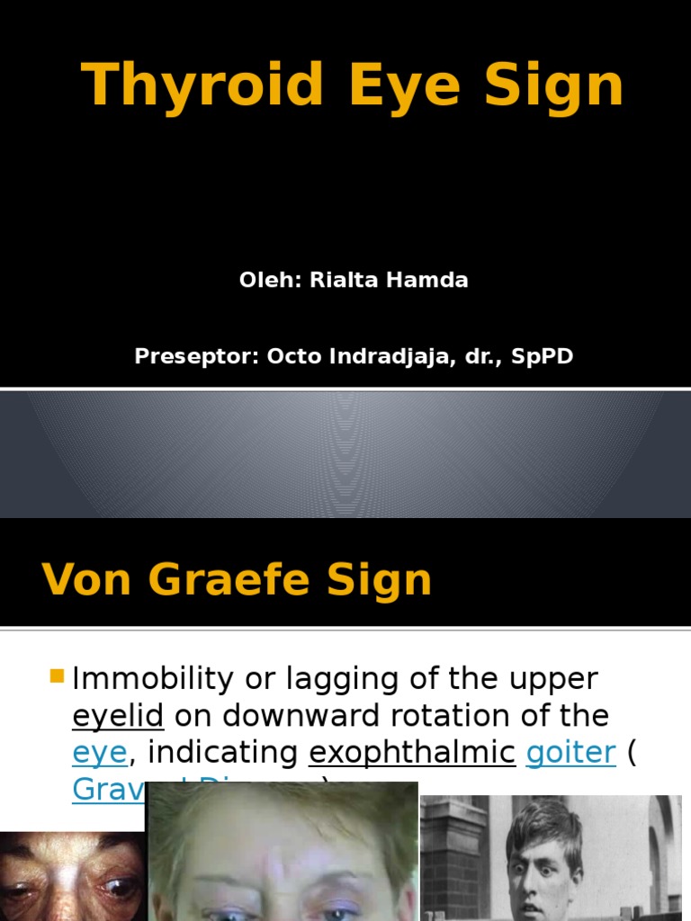 Von Graefes Sign