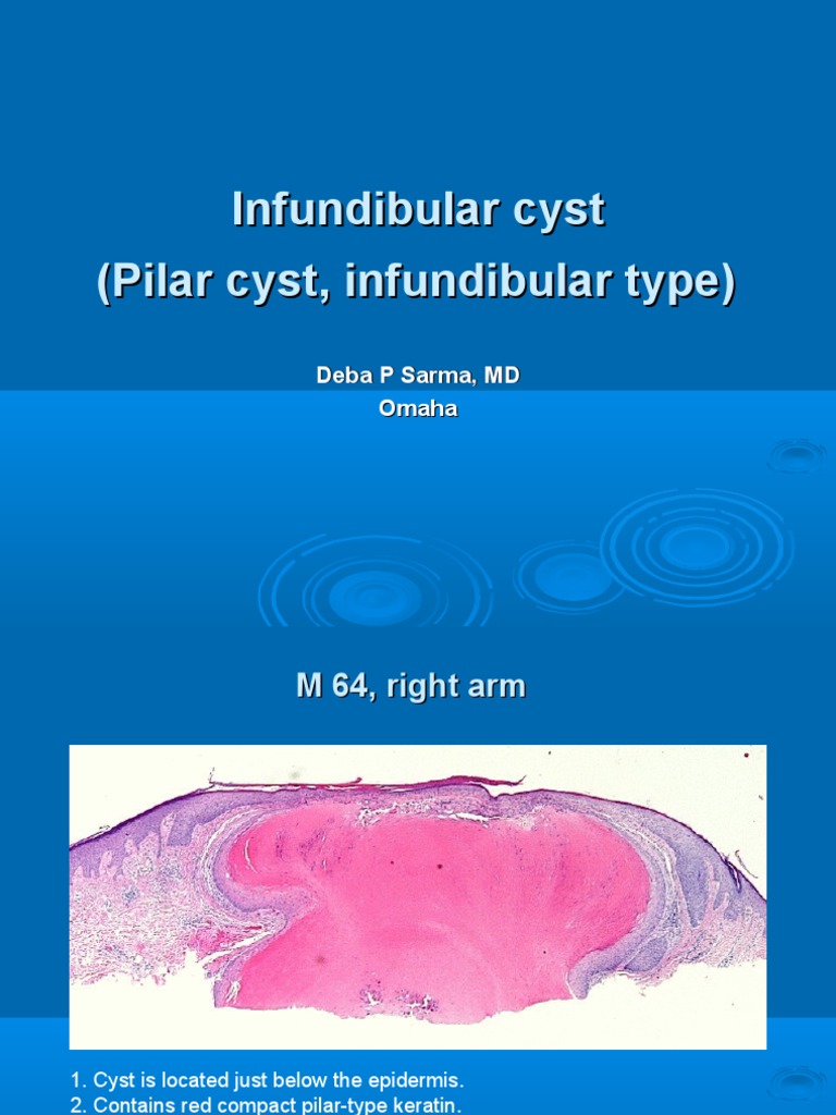 Infundibular Cyst. M 64, Right Arm. | PDF