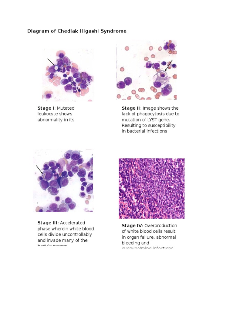 Diagram of Chediak Higashi Syndrome | PDF