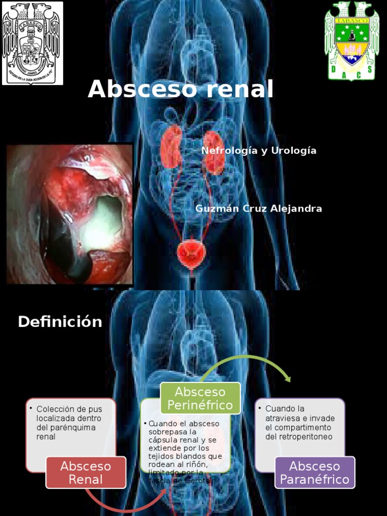 Alejandra Guzman Cruz-Absceso Renal | PDF | Riñón | Especialidades Medicas