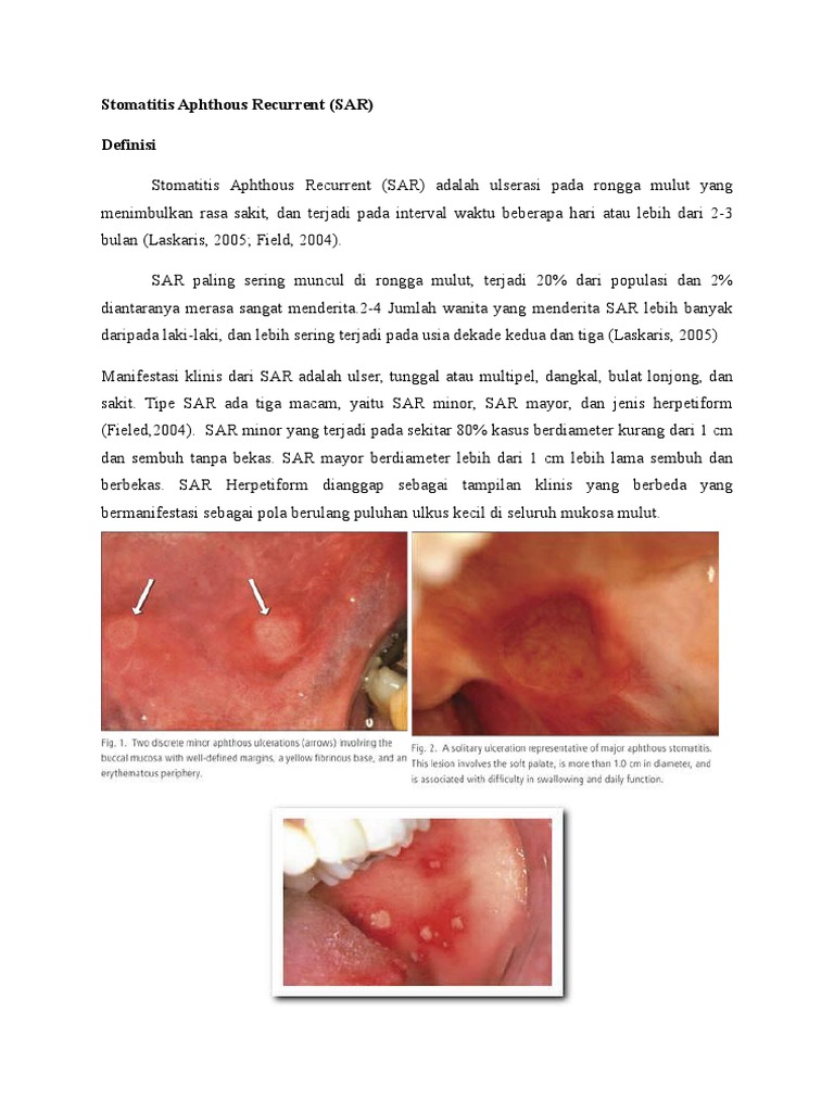 Stomatitis Aphthous Recurrent | PDF | Kajian Bahasa Asing | Kesehatan ...