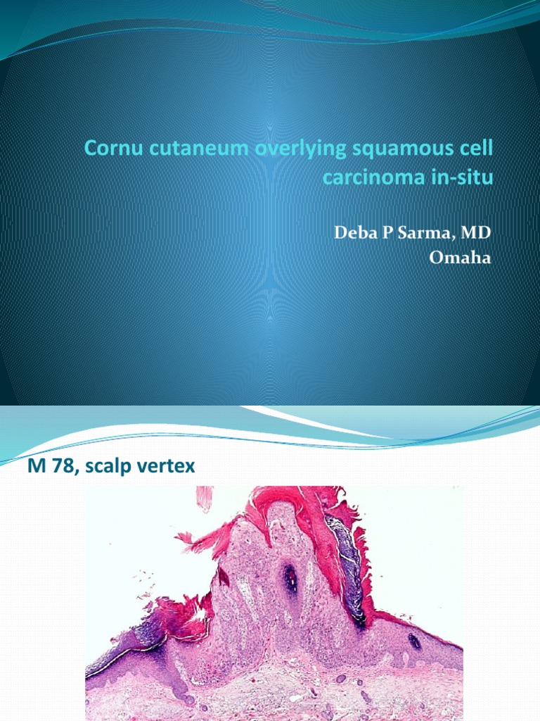 Cornu Cutaneum and Squamous Cell Carcinoma | PDF