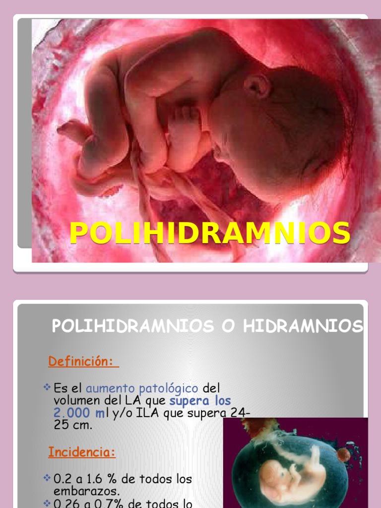 polihidramnios- | Parto | Feto