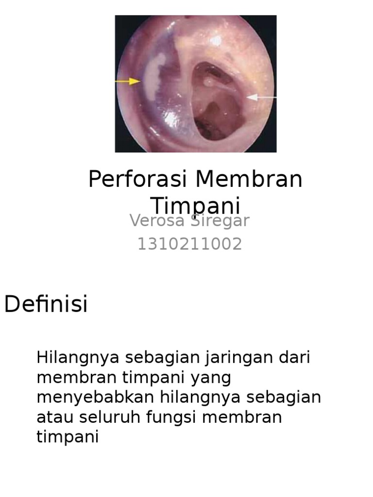 Perforasi Membran Timpani | PDF