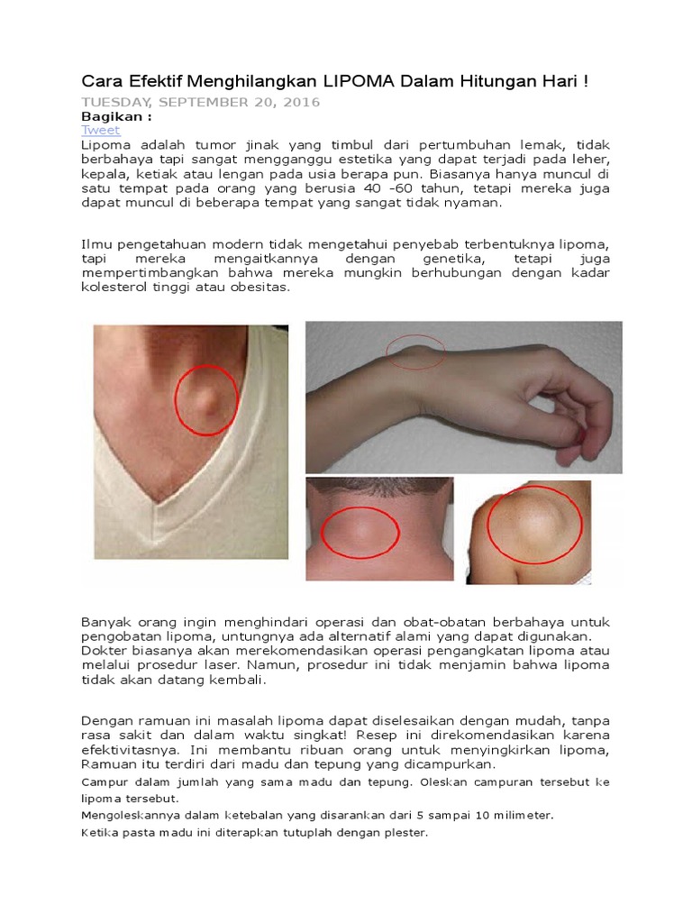 Cara Efektif Menghilangkan LIPOMA Dalam Hitungan Hari | PDF