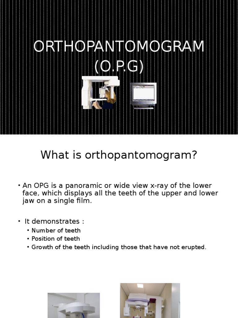 Orthopantomogram Meaning Why Use A Palatal Expander In Orthodontics?