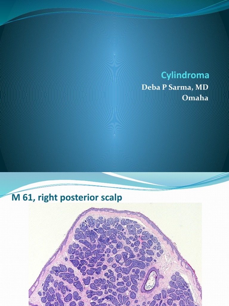 Cylindroma Case Study: Scalp Tumor | PDF