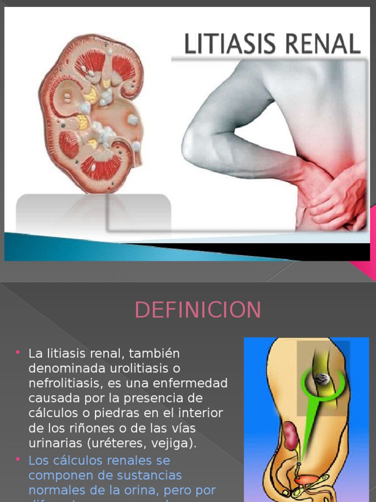 Litiasis Renal: Qué Es, Causas, Síntomas Y Tratamiento – FFLR